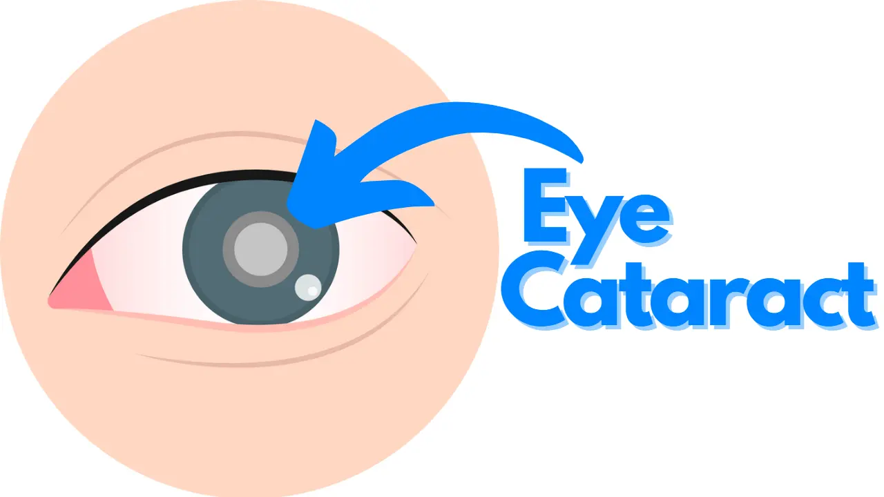 Cataracts: Symptoms, Causes & Treatment - Eye Conditions Explained
