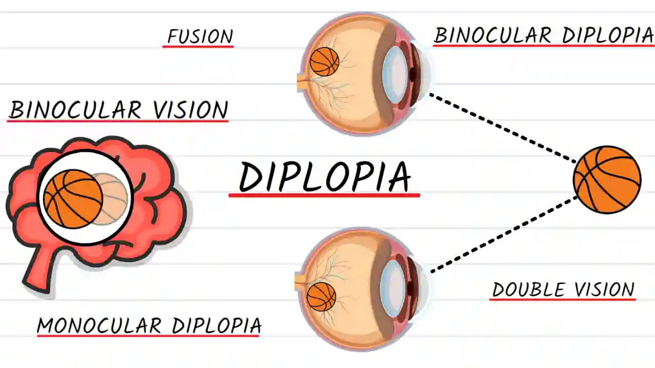 Double Vision (Diplopia) Explained - Eye Conditions Explained