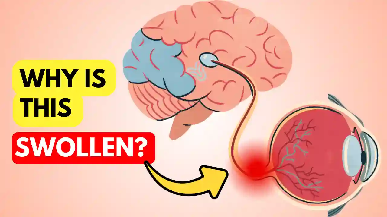 Papilledema: Optic Disc Swelling From High ICP - Eye Conditions Explained